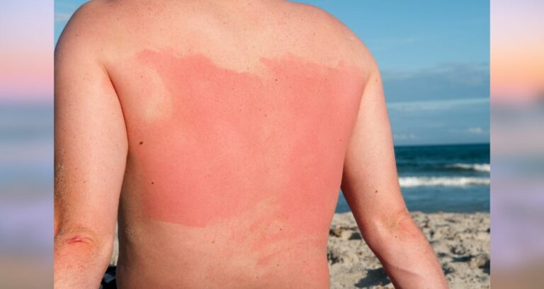 Cómo diferenciar una reacción alérgica a un medicamento de una reacción por fototoxicidad | SEAIC